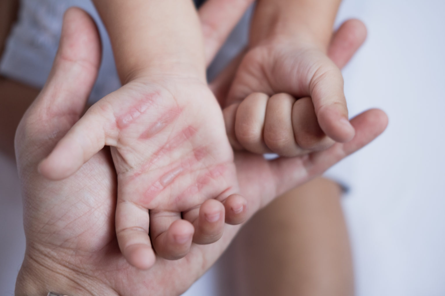 What Is the Fastest Way to Heal a Second-Degree Burn? | Oxford Urgent Care