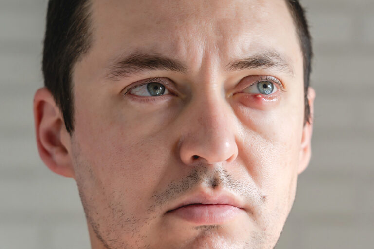 Eyelid Styes | When Is It Time to Visit Urgent Care?
